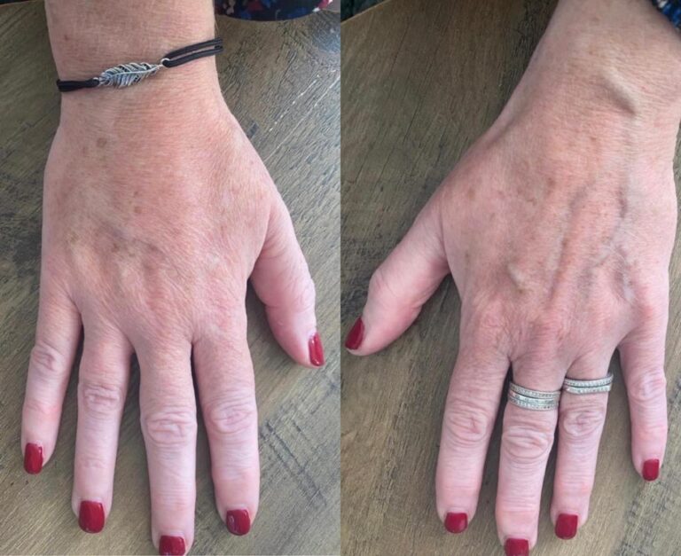 Profhilo treatment London. Free Consultation. Prices from £295