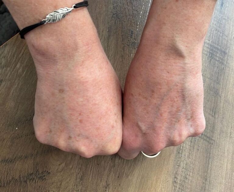 Profhilo treatment London. Free Consultation. Prices from £295