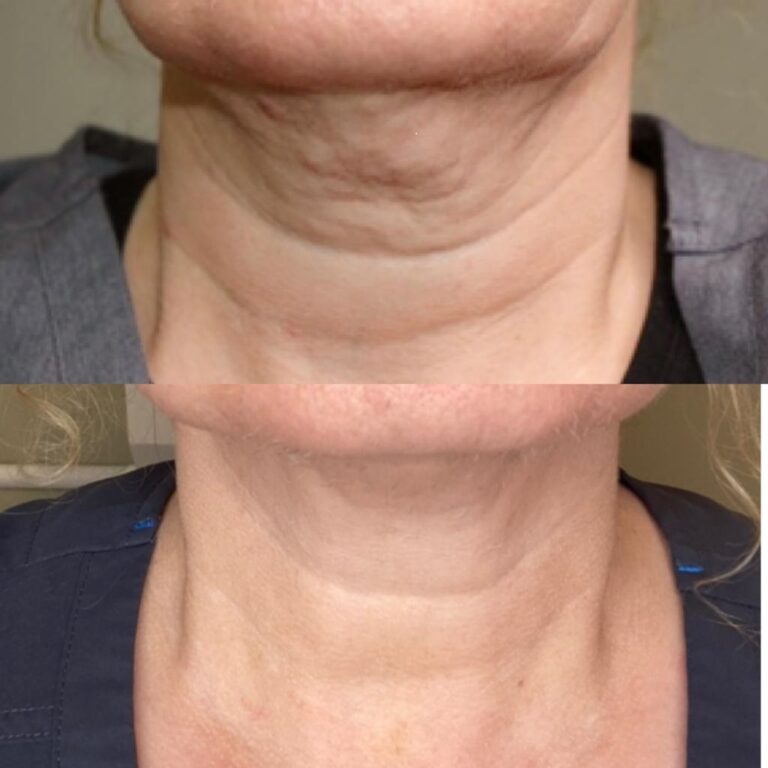 Profhilo treatment London. Free Consultation. Prices from £295