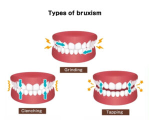 Michigan splint and Tanner splint (for Bruxism) - Thurloe Street Dental ...